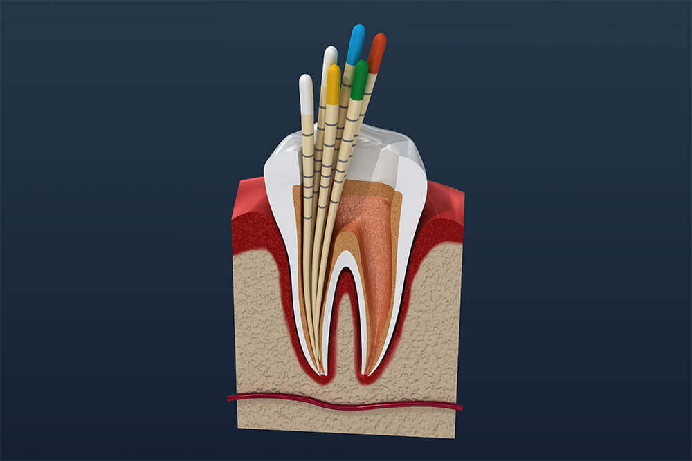 Root Canal Symptoms To Watch Out For Ace Dental Boston
